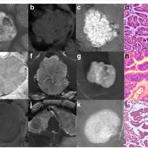 Drugs That May Influence Csf Production At Choroid Plexus Level And
