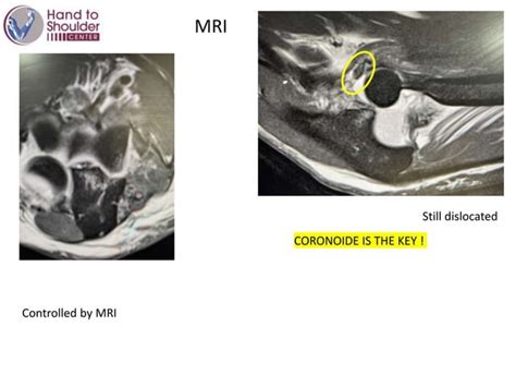 Coronoid Fracture Fix Or Notpptx Death Injury Or Military