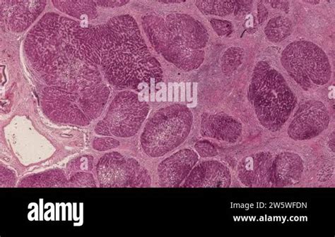 Cross Section Cut Of Liver Cirrhosis Under The Microscope Stock Video Footage Alamy