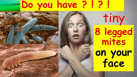 Demodex Mites Mites On Your Face Youtube