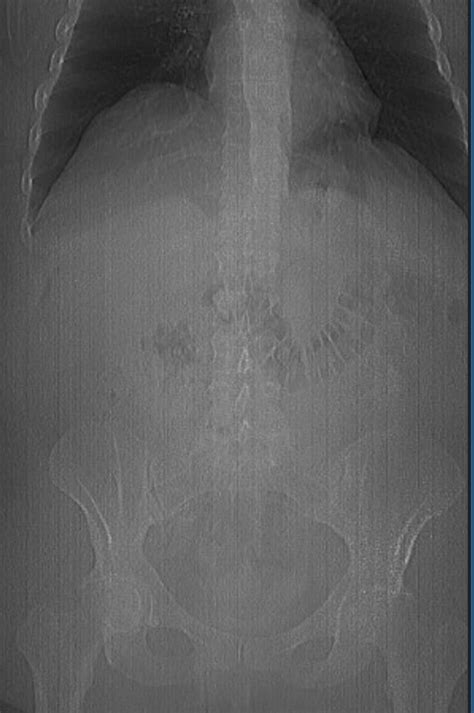Jejunal Diverticulitis And Sex R Diverticulitis