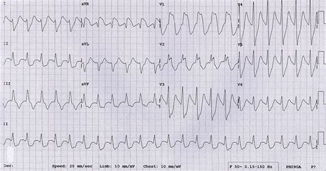 Right Axis Deviation Ecg Book