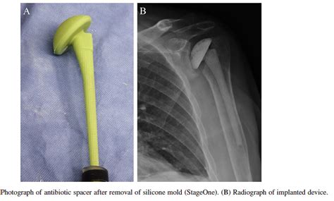 Uw Shoulder And Elbow Academy Are Antibiotic Spacers A Benign