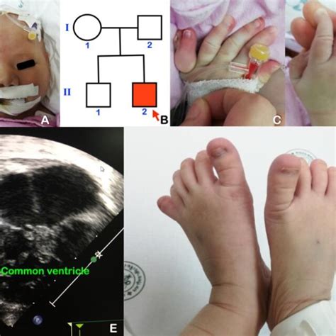 Patient 2 At Age 15 Months Had Bardet Biedl Syndrome Caused By A Download Scientific Diagram