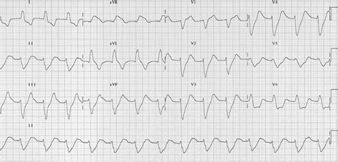 Hyperkalemia Ekg