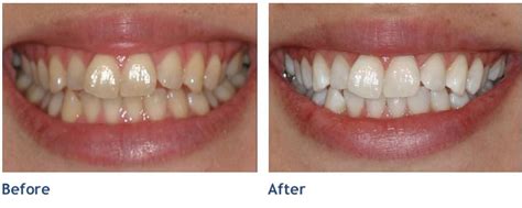 როგორ გავითეთროთ კბილები სახლის პირობებში პროფესიონალურ წმენდაზე