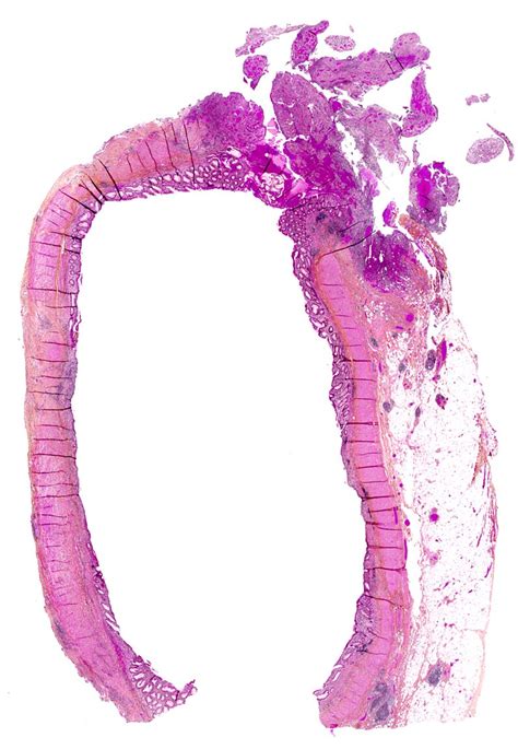 Acute Appendicitis Human Pathology