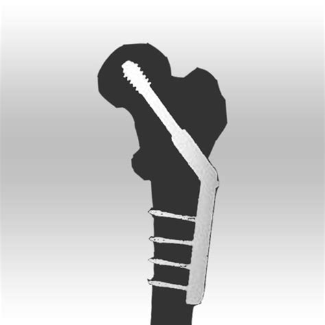 Hip Fracture Risk Calculator By David Zhu