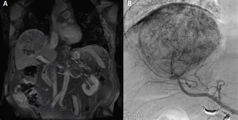 Liver Embolization Endovascular Today