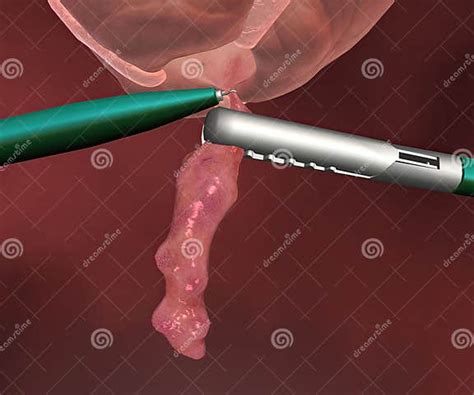 3d Rendering Of Metal Tool And Closeup Of Appendicitis Painful