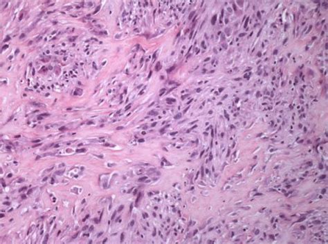 Malignant Lace Like Osteoid Formation Notice The Nuclear Polymorphism