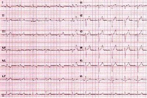 El Conocimiento Del Electrocardiograma Ekg Como Herramienta