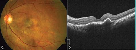 Managing Massive Submacular Hemorrhage Using Intravitreal Brolucizumab In Combination With