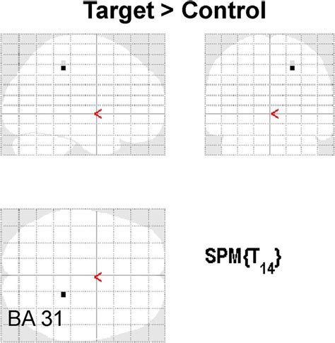 Statistical Parametric Map Statistical Parametric Map Of The Brain