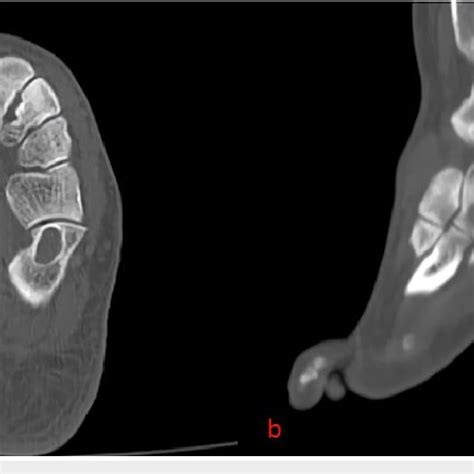 Mass Surrounded By Sclerotic Rim Adjacent To The Calcaneocuboid Joint Download Scientific