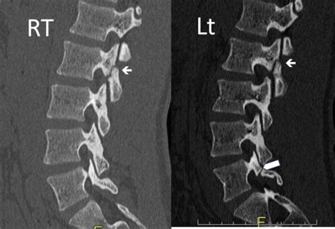 The Value Of Bone Scan And Pars Injection In Nonadjacent Pars Fractures The Spine Journal
