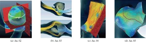 Exploration Of Different Datasets The Aneurysm Exploration Widget In Download Scientific