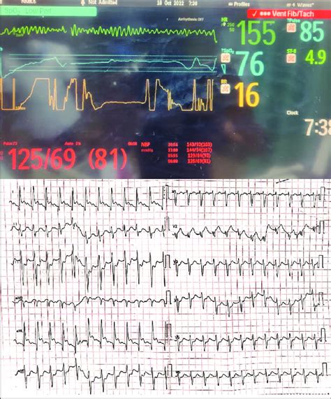 Upper Panel Shows Monitor Electrocardiographic Trace With Ventricular
