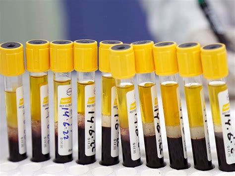 What Is Ldl Hdl Ratio In Blood Test Results Interpretation What Is Ldl Hdl Ratio In Blood Test Results Interpretation