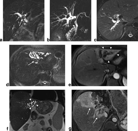 Cholangiocarcinoma Radiology
