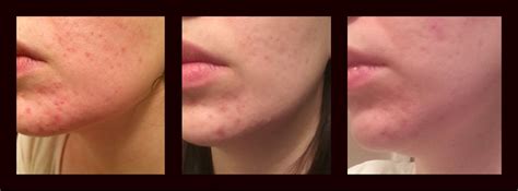 Momma Of Two Review Vitamin C Serum To The Rescue