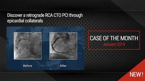 Retrograde Rca Cto Pci Through Epicardial Collaterals