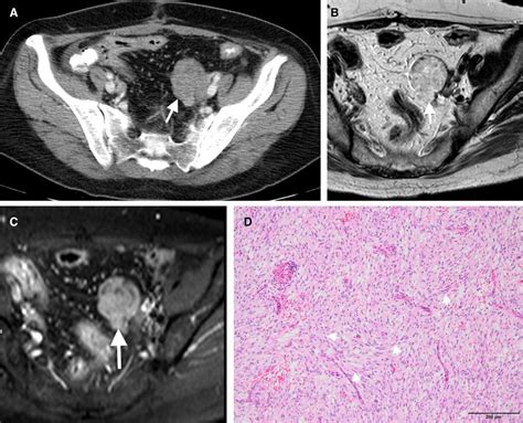 Sixty Two Year Old Woman With A History Of Ileal Gist Treated With