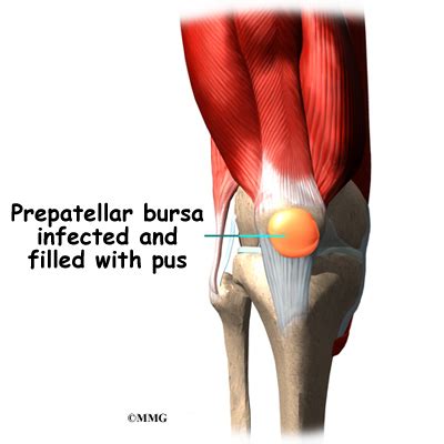 Hard Lump On Knee