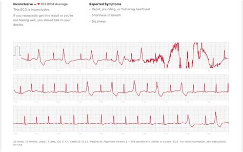 Inconclusive Apple Ecg Anyone Shed Some Light R Readmyecg