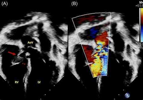 Twodimensional Transthoracic Echocardiographic Image Along With Color Download Scientific