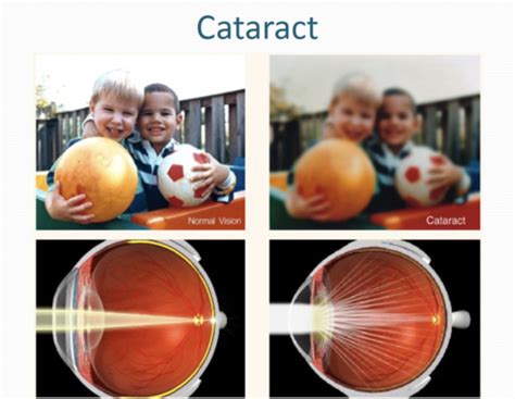 Adult Visual Abnormalities Flashcards Quizlet Adult Visual Abnormalities Flashcards Quizlet
