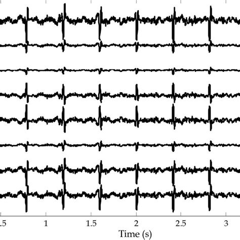 Pdf Independent Component Analysis In Ecg Signal Processing