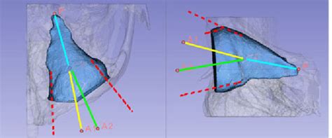 Figure 1 From Orbit Segmentation By Surface Reconstruction With Automatic Sliced Vertex
