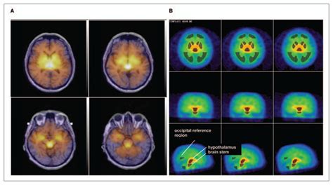 I 123 Adam And Spect In Patients With Borderline Personality Disorder