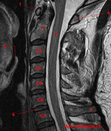 Cervical Spine Mri Labeled