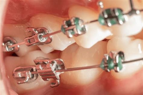 traditional metal braces in portland magic smiles