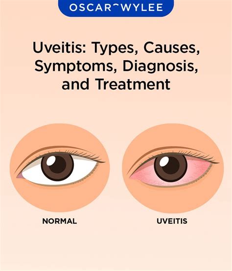 Uveitis Uveitis Eye Causes Types Symptoms Diagnosis
