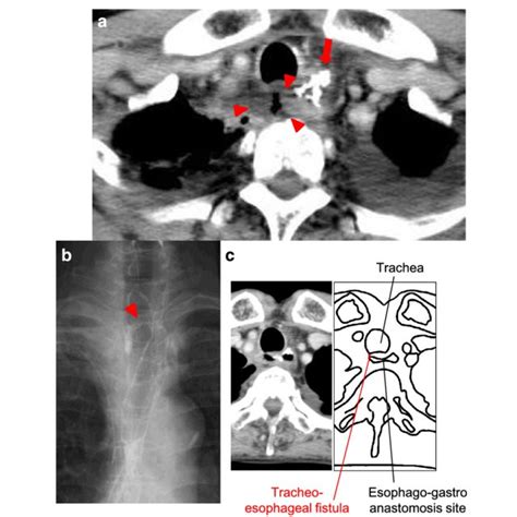 Image Findings Of Postoperative Abscess And Tracheoesophageal Fistula