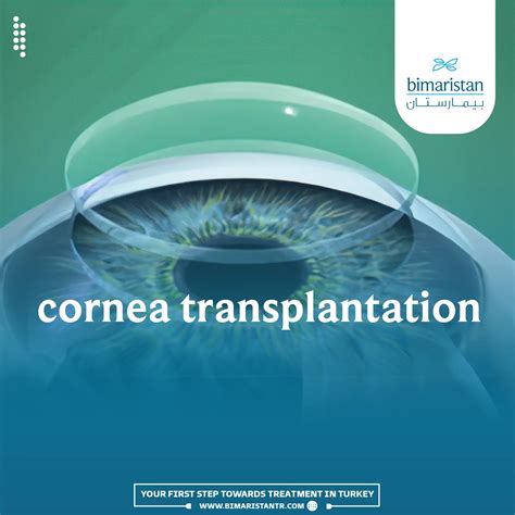 Corneal Transplantation 2025 In Turkey بيمارستان
