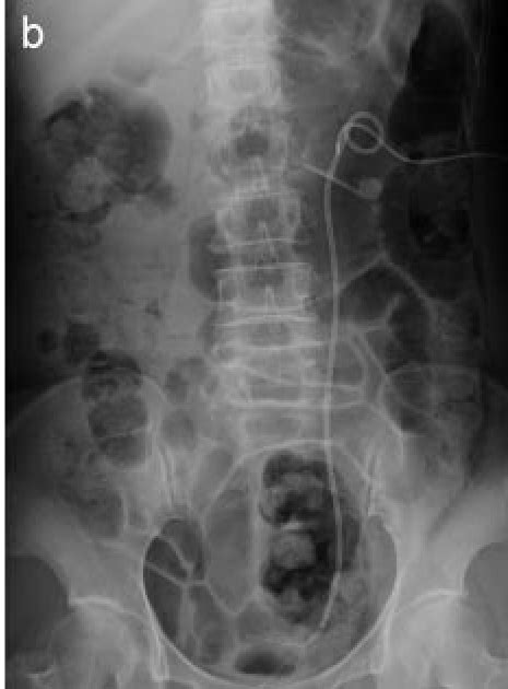 Puncturing Under Ureteroscopy Guidance Download Scientific Diagram