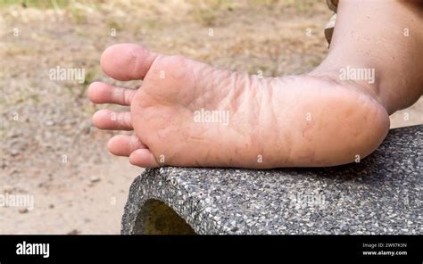 Woman Is Suffering From Foot Sore Caused By Athletes Foot Patient Is