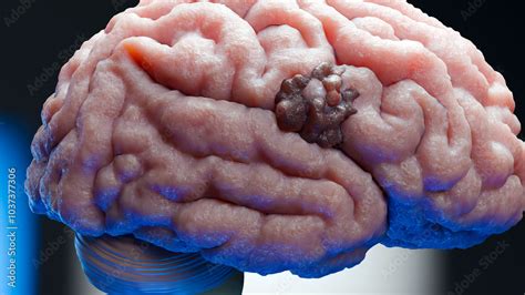 Human Brain Nervous System Anatomy Neural Cancer Sebaceous Bulb