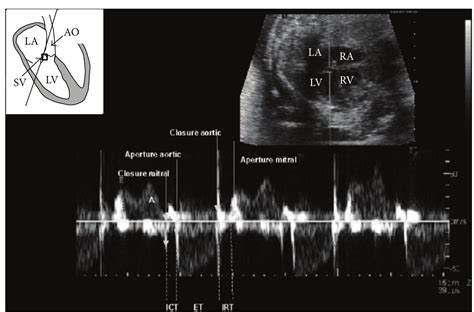 Figure 3 The Fetal Modified Myocardial Performance Index