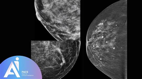 Microcalcifications On Mammogram What Do They Mean