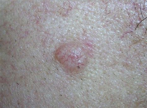Basal Cell Carcinoma Bcc Of Skin Of Other Parts Of Face Icd 10