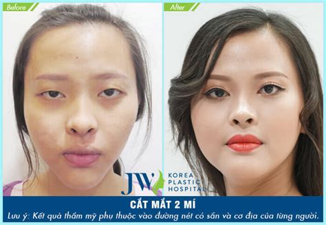 Types Of Eye Surgery JW Korean Plastic Hospital