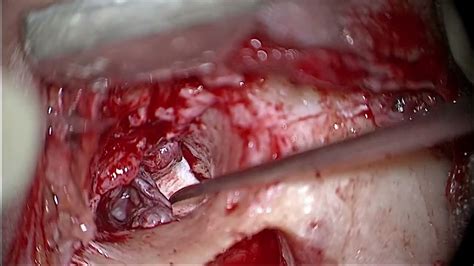 Mastoidectomy With Atticotomy Youtube