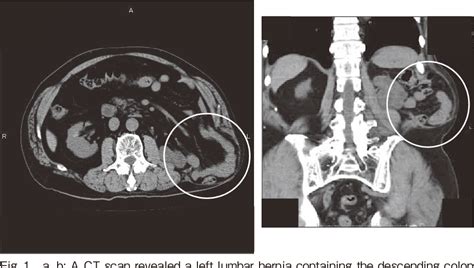 Figure 1 From Laparoscopic Repair Of Left Lumbar Hernia After Left Nephrectomy Semantic Scholar