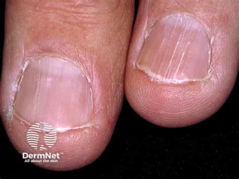Nail Lichen Planus Images — Dermnet