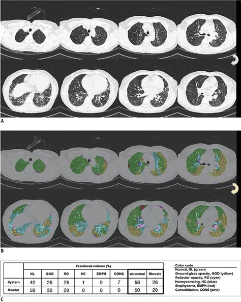 Interstitial Pneumonias An Acute Reticular Pattern Is Most
